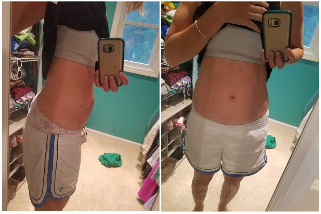 Diastasis Recti Before And After [without Surgery] Lucies List